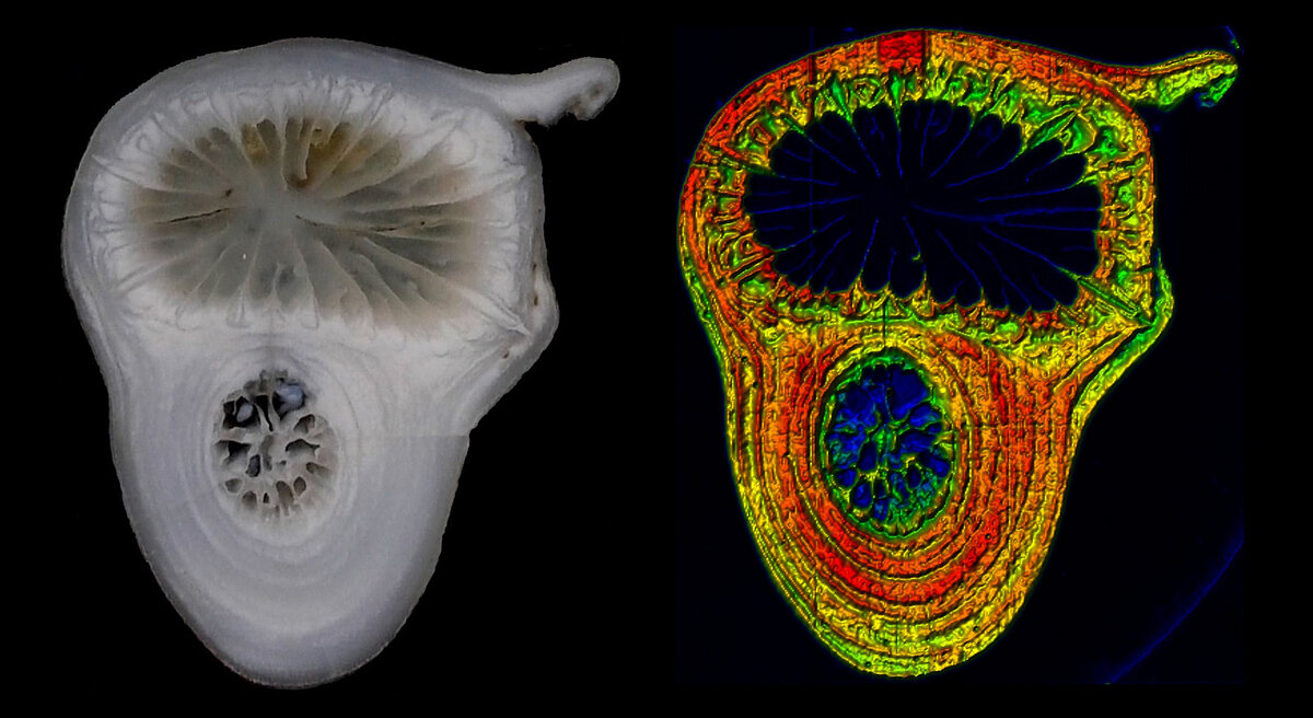 Laser-sharp insights into calcification